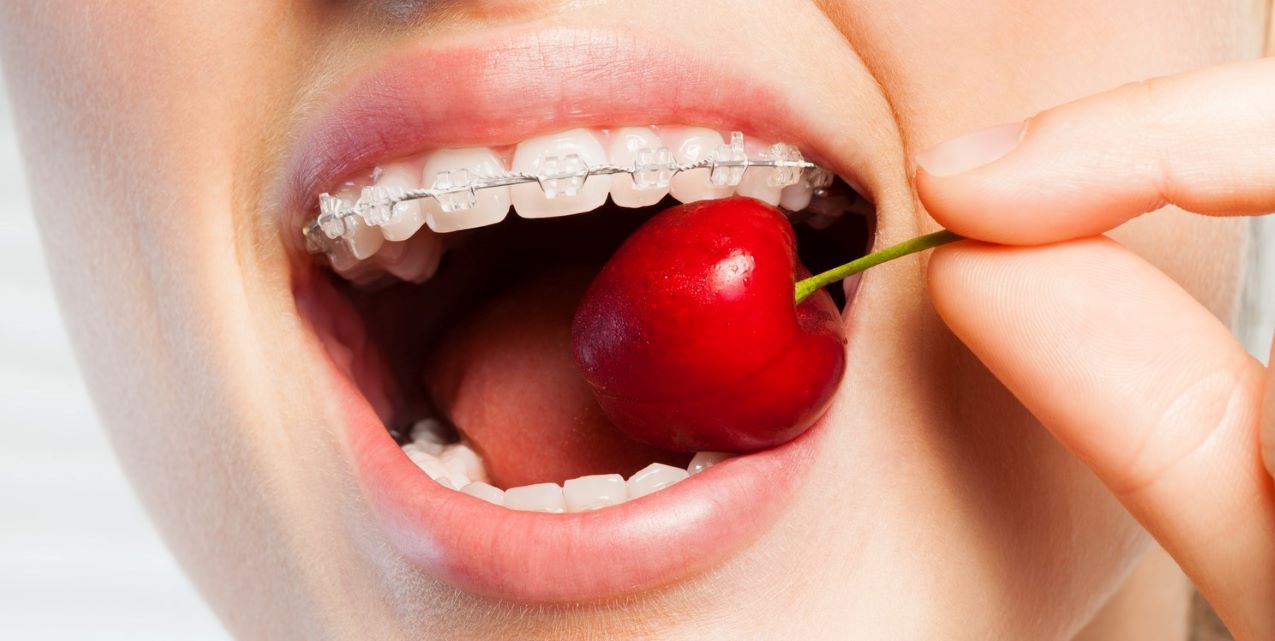 Frenos Transparentes en Las Vegas | Absolute Dental